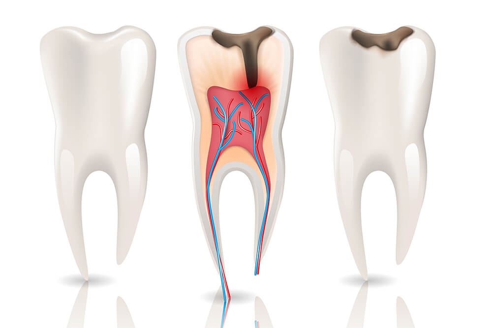 Severe Tooth Decay: How Does It Occur? - Summit Family Dentistry